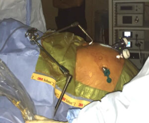 Holding and Positioning Arms - Surgical Principals Inc.